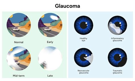 Neovascular Glaucoma Premium Vector Inflammatory Glaucoma