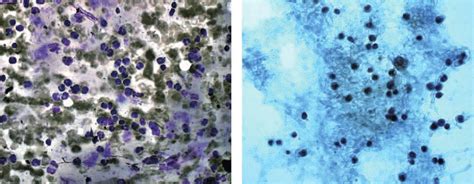 Thyroid Fna Specimen A Diff Quick Staining Shows Numerous Download Scientific Diagram