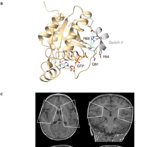 Rac1 Switch Ii Variants Cause A Neurodevelopmental Disorder A Download Scientific Diagram