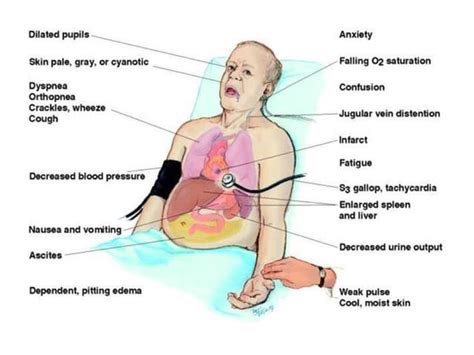 Chf Heart Failure And Classification 4pptx