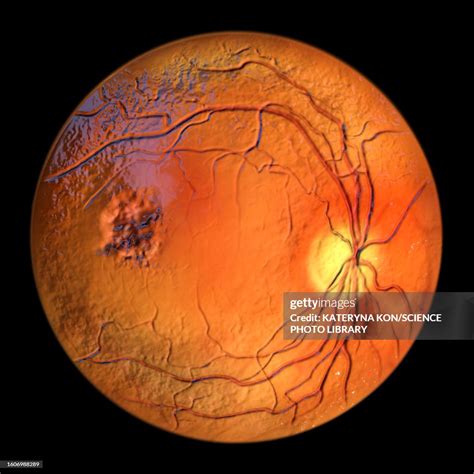 Best Vitelliform Macular Dystrophy Illustration High Res Vector Graphic