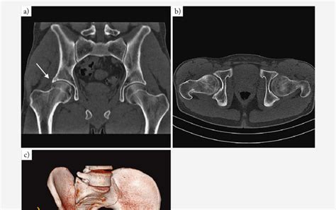 Preoperative Pelvic Multi Slice Computerized Tomography With Residual