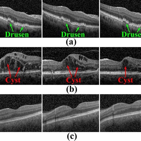 Automatic Classification Of Volumetric Optical Coherence Tomography Images Via Recurrent Neural
