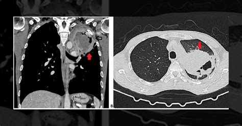 Challenging Diagnosis Of A Patient With Digital Clubbing And Arthralgia
