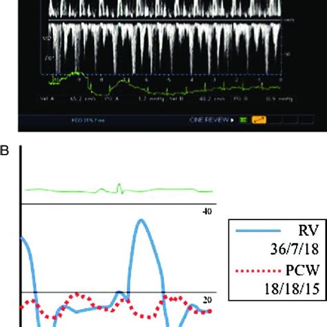 Cyclic Variation In Tricuspid Inflow Was Significantly Improved From Download Scientific