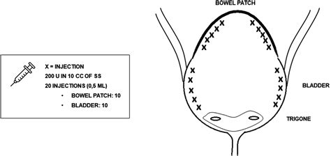 Medium And Long Term Results Of Botulinum Toxin Injection In Patients