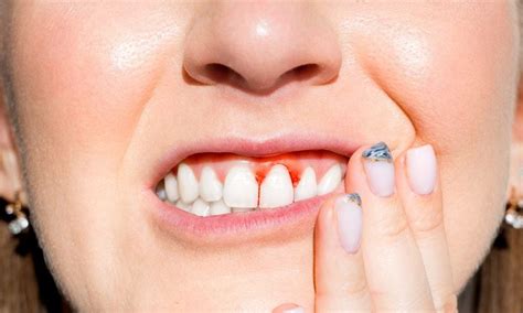 Understanding Gingivitis Causes Symptoms And Treatment Clamon