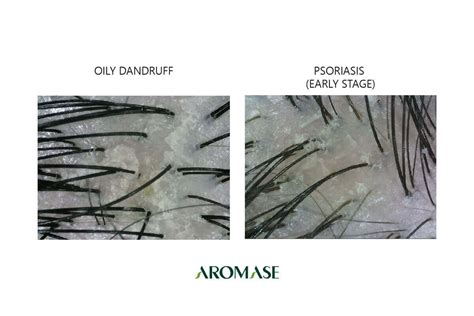 Dry Scalp Patches