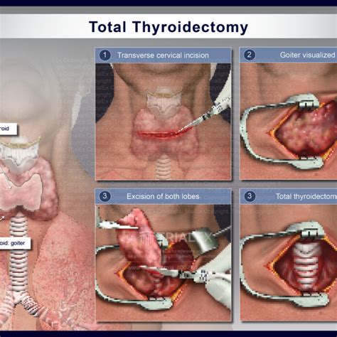 Medical Legal Exhibits Legal Animations And Trial Graphics Tria