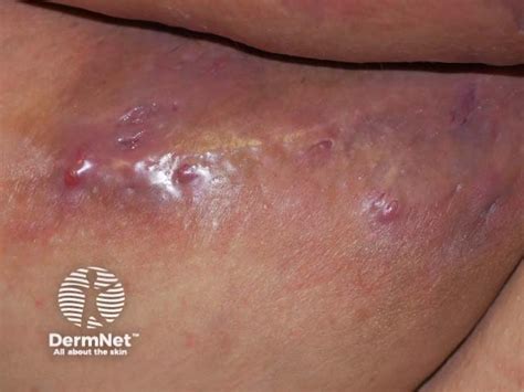 Hidradenitis Suppurativa Of Buttocks Image
