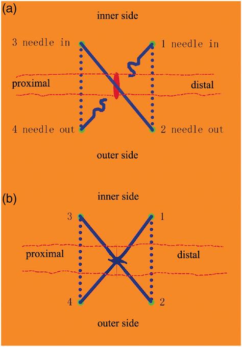 The Efficacy Of The Figure Of Eight Suture Technique In The Treatment