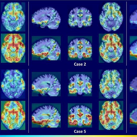 Heat Maps Highlighting Discriminative Regions Of Mci Conversion