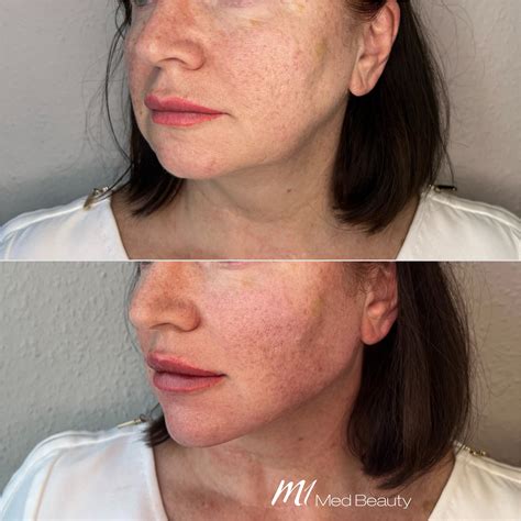 M1 Хармонизиране на лицето 👸 в M1 Med Beauty номер 1 за медицински естетични процедури в