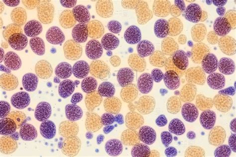 白细胞ai数字艺术 白血病科学医学风格血细胞红细胞白细胞血小板显微照片 图片免费下载 Png格式 4032像素 编号71435509 千图网