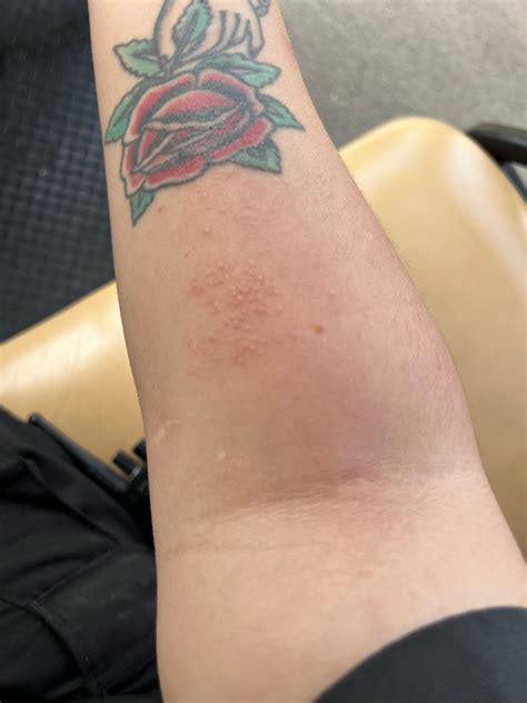 Itchy Bumps On Arm R Dermatologyquestions