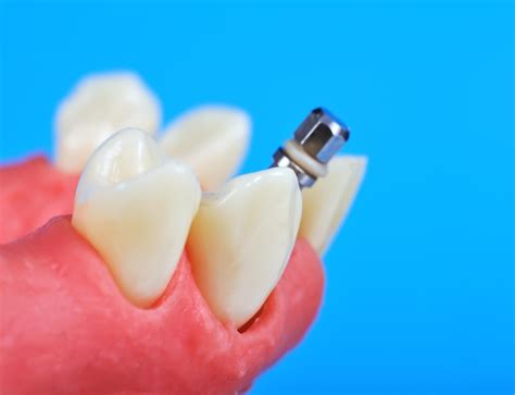 Premium Photo Dental Titanium Implant