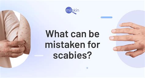 Miiskin Did You Know That Several Skin Conditions Can Mimic Scabies