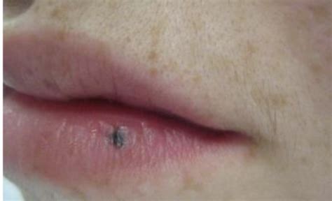 Dermatology Flashcards Quizlet