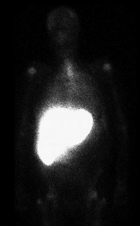 Technitium 99m Sulfur Bone Marrow Scan In Anteroposterior Orientation