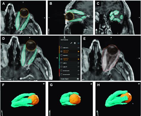Illustration Of The Semi Automatic Volumetry Technique A C Download Scientific Diagram
