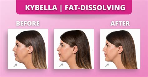 Kybella Fat Dissolving Injections — Our In Depth Review