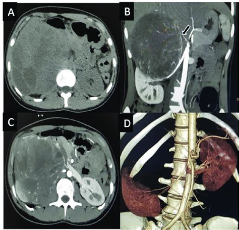 A Ct Non Contrast Images Revealing A Heterogenous Density Right Supra