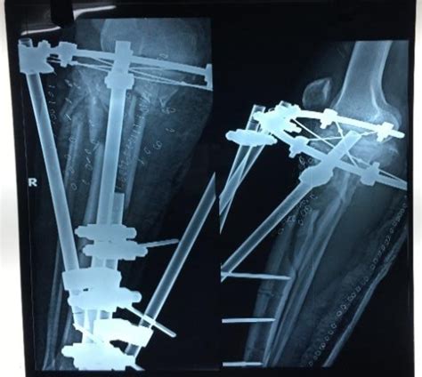 Postoperative X Ray Of Patient Treated With Hybrid External Fixator