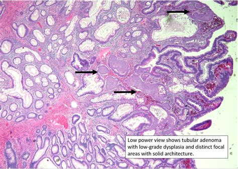 Tubular Polyp Tubular Adenomas How Serious Are They Facty Health