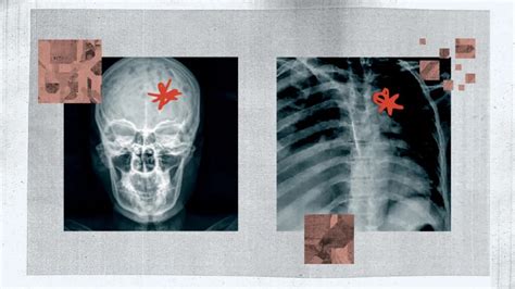 Multiple Lytic Bone Lesions Jmsr