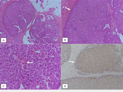Solid Papillary Carcinoma In Situ A H And E Sections At 40x Download Scientific Diagram