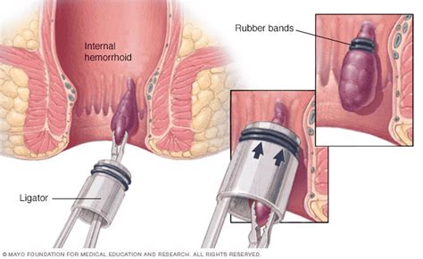 Hemorrhoid Band Ligation Upperhill Gastro