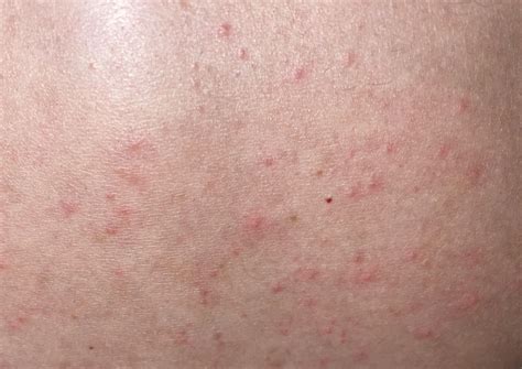 Rash After Epilating Lower Back Hyperpigmentation Rhairremoval