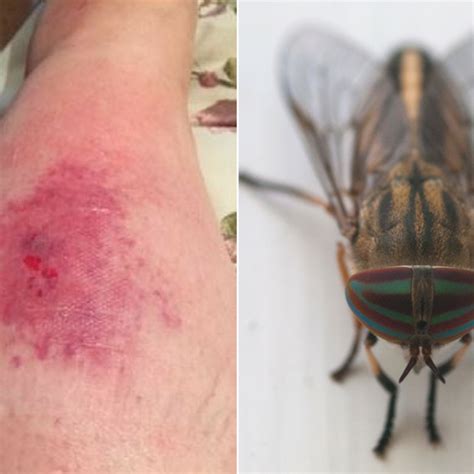 Horse Fly Bite