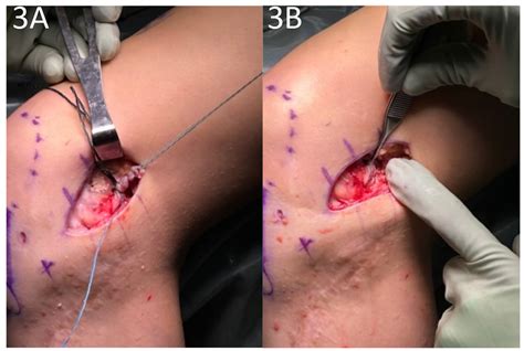 Why Your Patient May Need An Acl Reconstruction Plus Lateral Extra