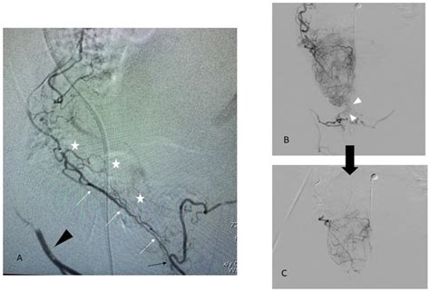 Prostate Artery Embolization Challenges Tips Tricks And Perspectives