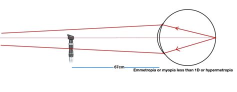 Retinoscopy Optominsight