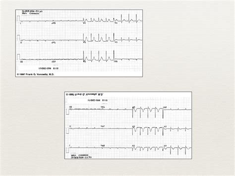 Ecg Interpretation Criteria Review Axis Deviation Left Right