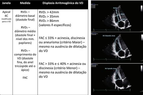 Cardiomiopatia Arritmogênica Do Ventrículo Direito Critérios Ecocardiográficos Blog Ecope