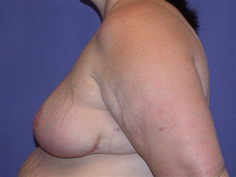 Case 10 Seattle Plastic Surgery Award Winning Surgeon Drshahram