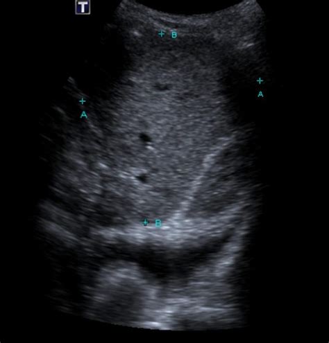 Tuberculosis Esplénica Asociada A Infección Por Vih Reporte De Un Caso