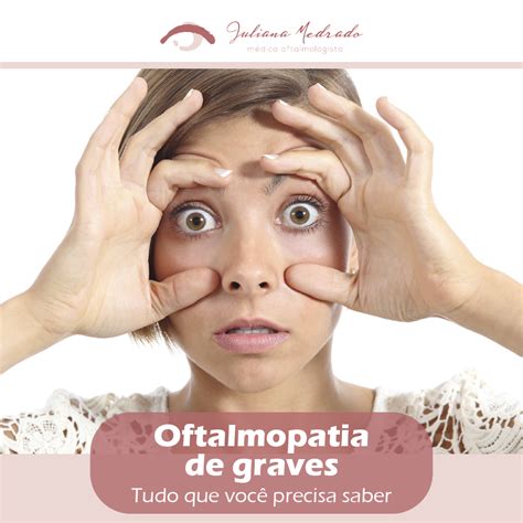 Oftalmopatia De Graves Dra Juliana Medrado Médica Oftalmologista