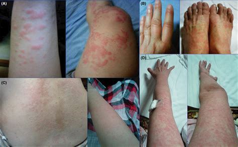 Rashes On Legs And Arms