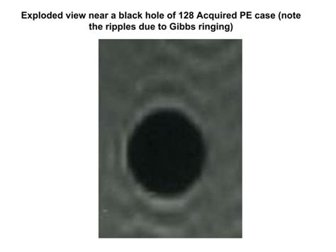 Mri Gibbs Ringing Artifact Reduction Ppt