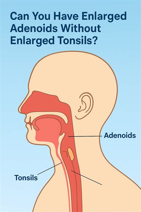 Can You Have Enlarged Adenoids Without Enlarged Tonsils