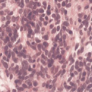 PDF Diagnosis And Management Of Synovial Sarcoma