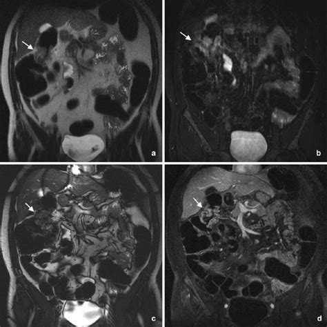 Ad Contrast Encoding In Contrast Enhanced Ct Colonography 8 Mm Polyp