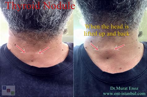 Thyroid Nodules Definition Causes Symptoms And Treatment
