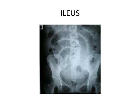 Ppt Surgical Complications Powerpoint Presentation Free Download