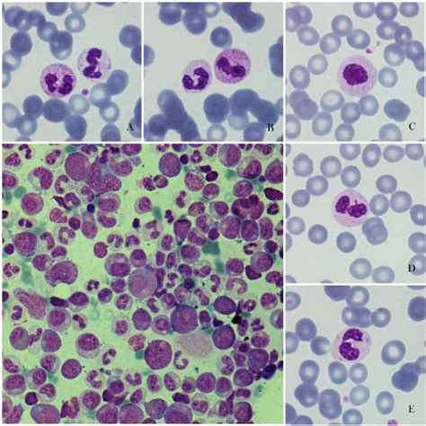 Atypical Chronic Myeloid Leukaemia