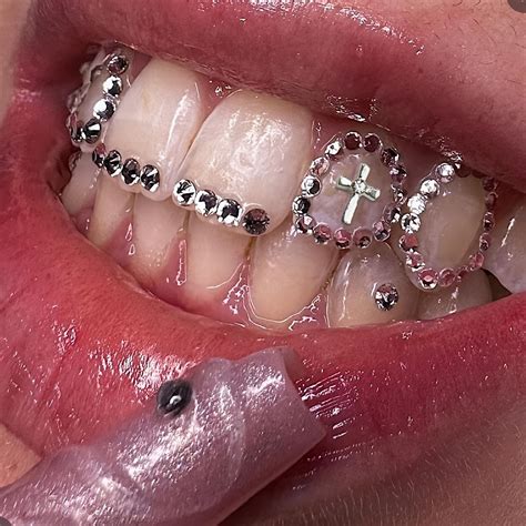 Pretty Braces Tumblr